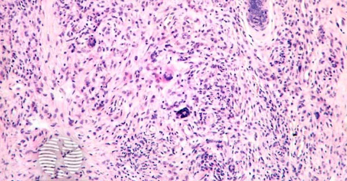 Juvenile Xanthogranuloma Image