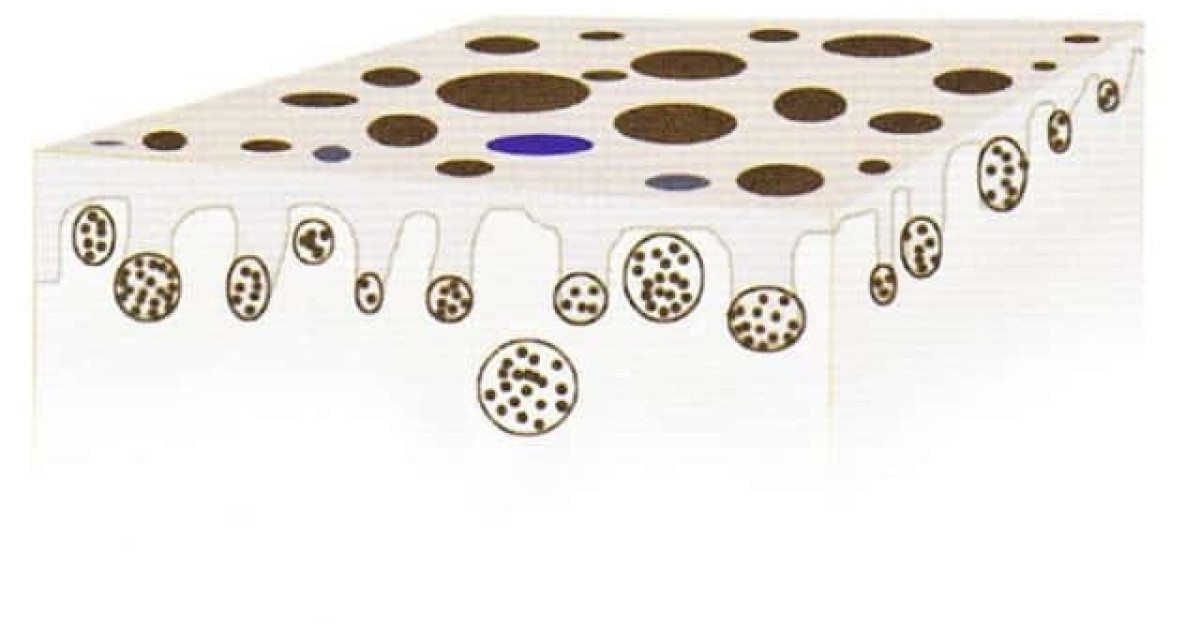 Brown, grey and blue clods on dermatoscopy. From Kittler H et al. image