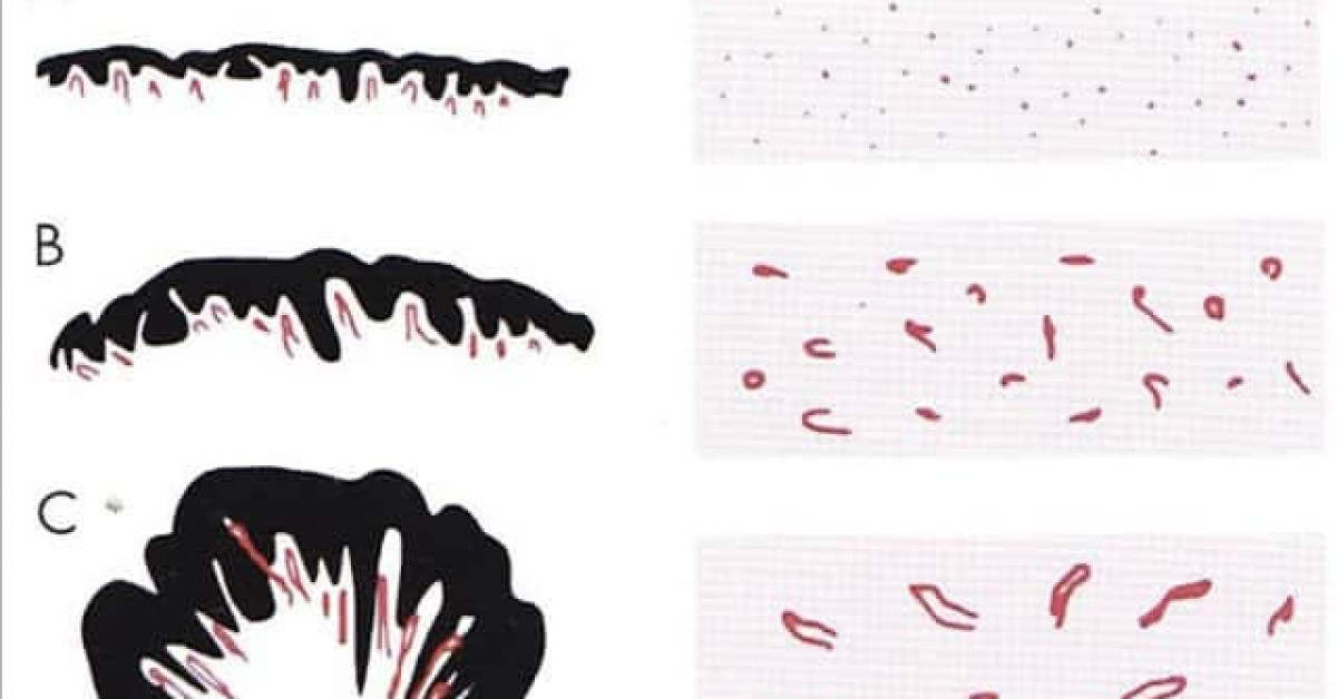 DermNet® - Dermatoscopic vascular patterns related to histopathology ...