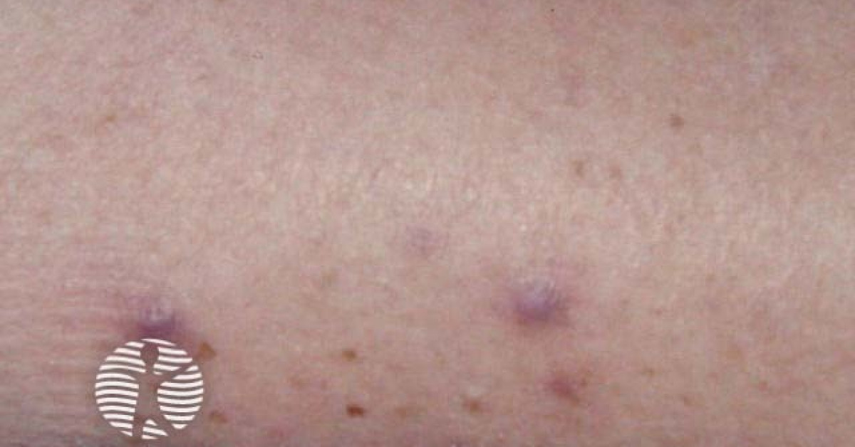 Kaposi sarcoma image