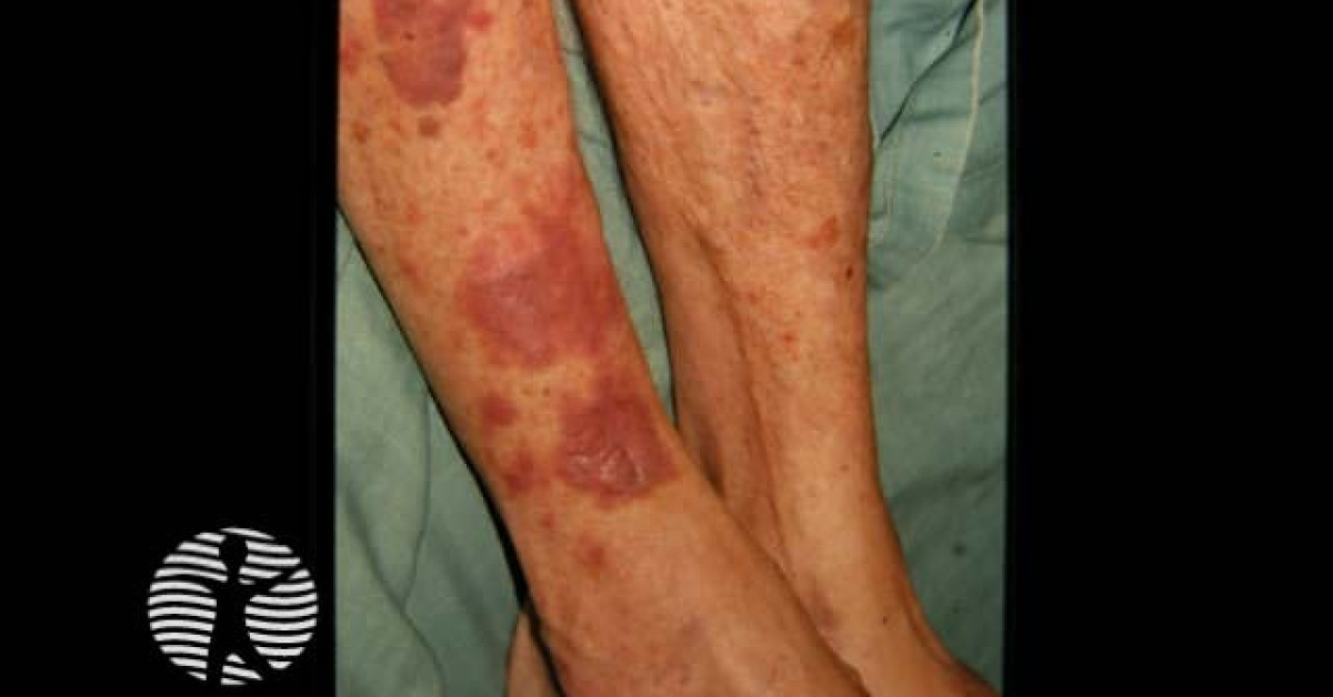 Kaposi sarcoma image