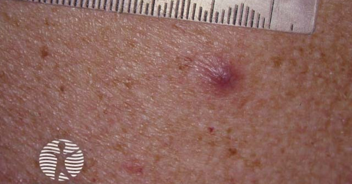 Kaposi sarcoma image