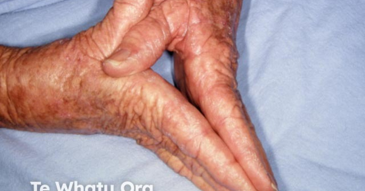 Keratoelastoidosis marginalis image