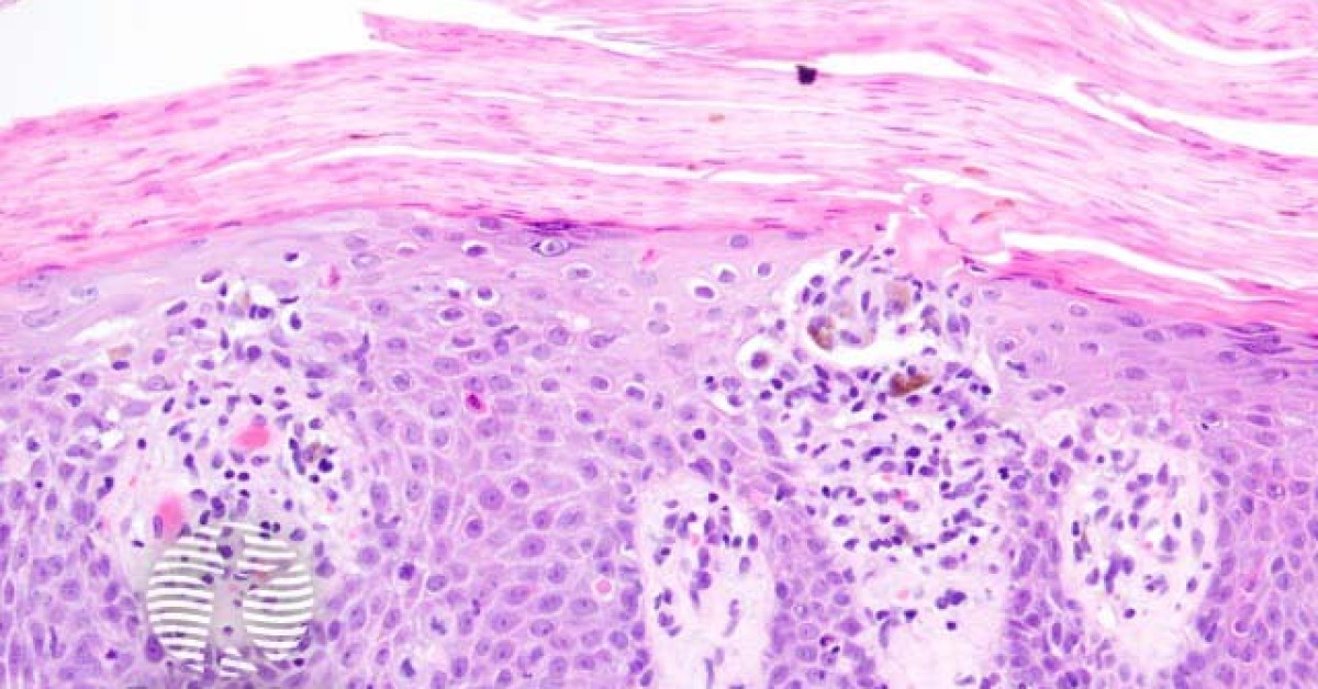 keratosis lichenoides chronica figure 5 image