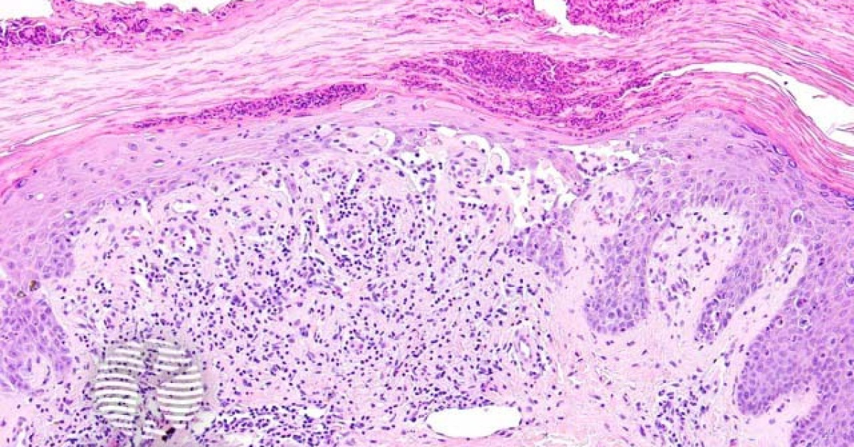 keratosis lichenoides chronica figure 6 image