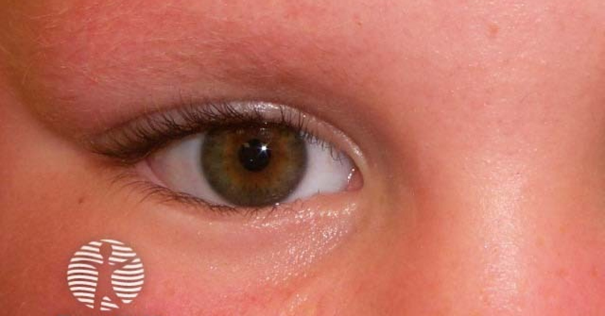 Keratosis pilaris faciei atrophicans image