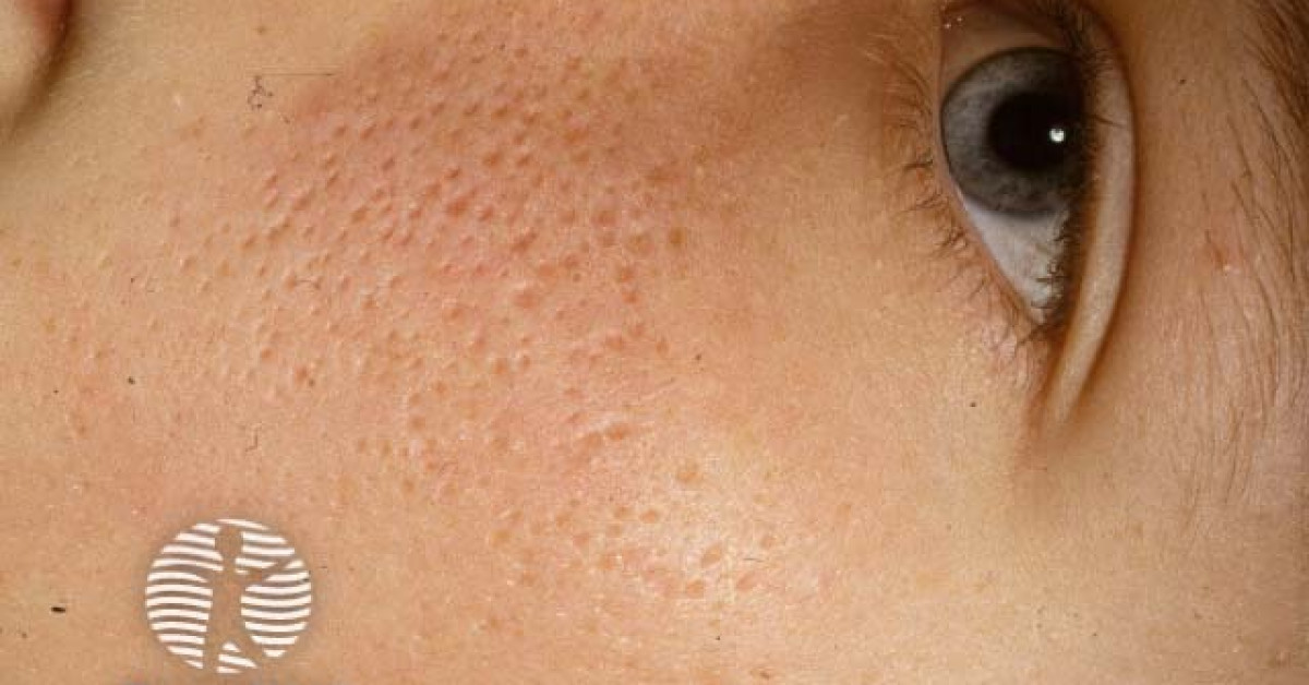 Atrophoderma vermiculatum image