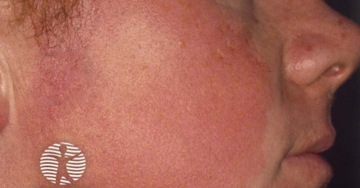keratosis pilaris faciei 09 image