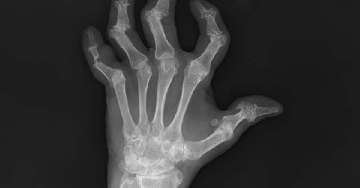 X-ray of left hand affected by psoriatic arthritis image
