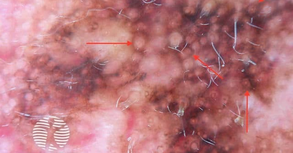 Concentric circles (red arrows) seen in dermoscopy of lentigo maligna ...