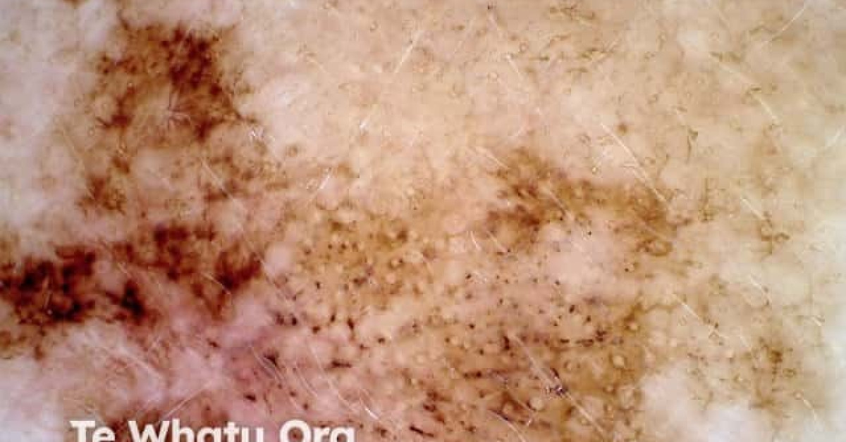 Asymmetrical pigmented follicular openings in lentigo maligna ...