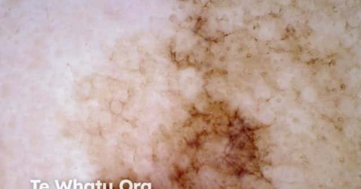 Asymmetrical pigmented follicular openings in lentigo maligna ...