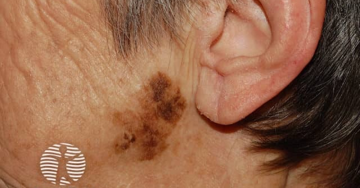 Lentigo maligna melanoma 1.7 mm image