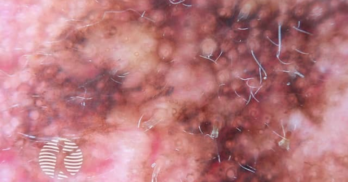 Pseudonetwork, structureless areas, grey and concentric circles seen in ...