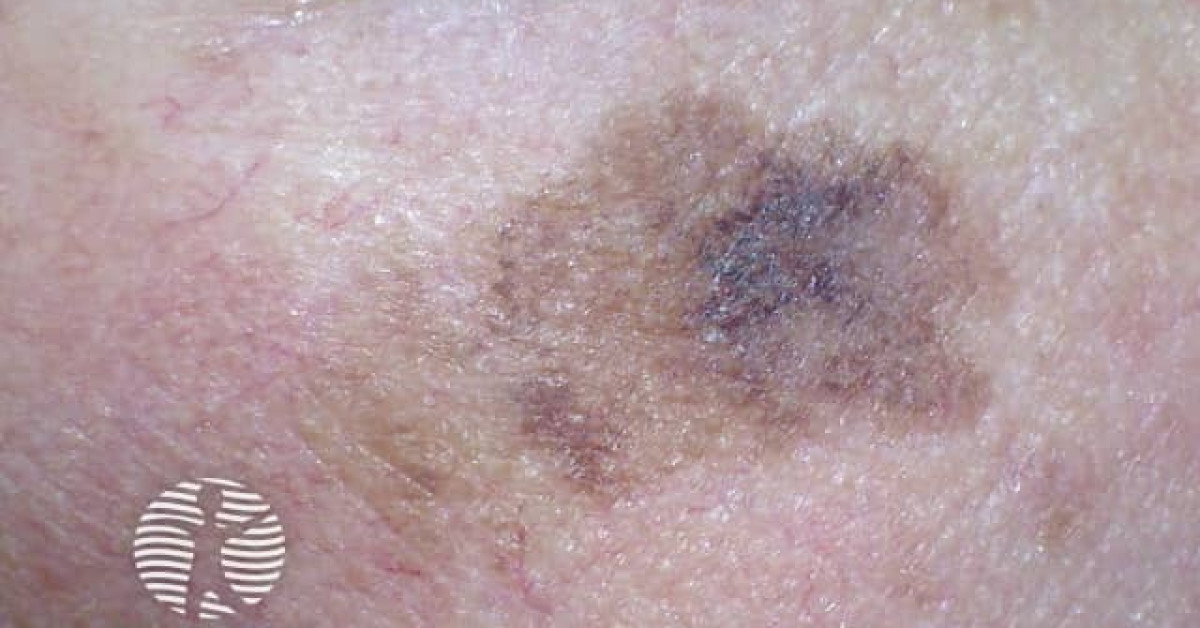 Lentigo maligna image
