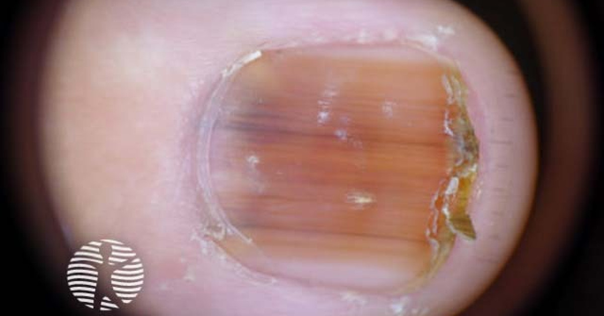 Lentigo simplex of the nail image