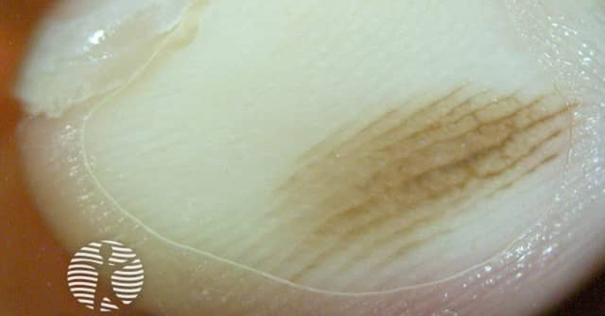 Dermoscopy: acral naevus image