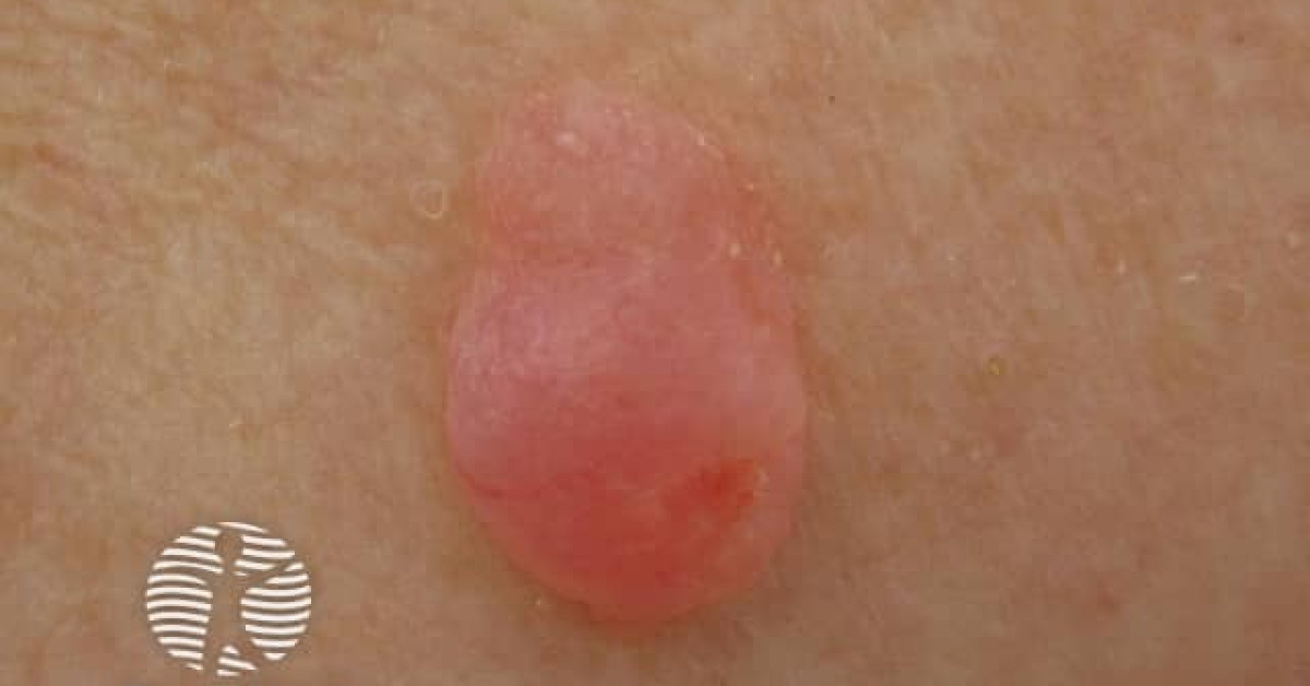 Atypical fibroxanthoma image