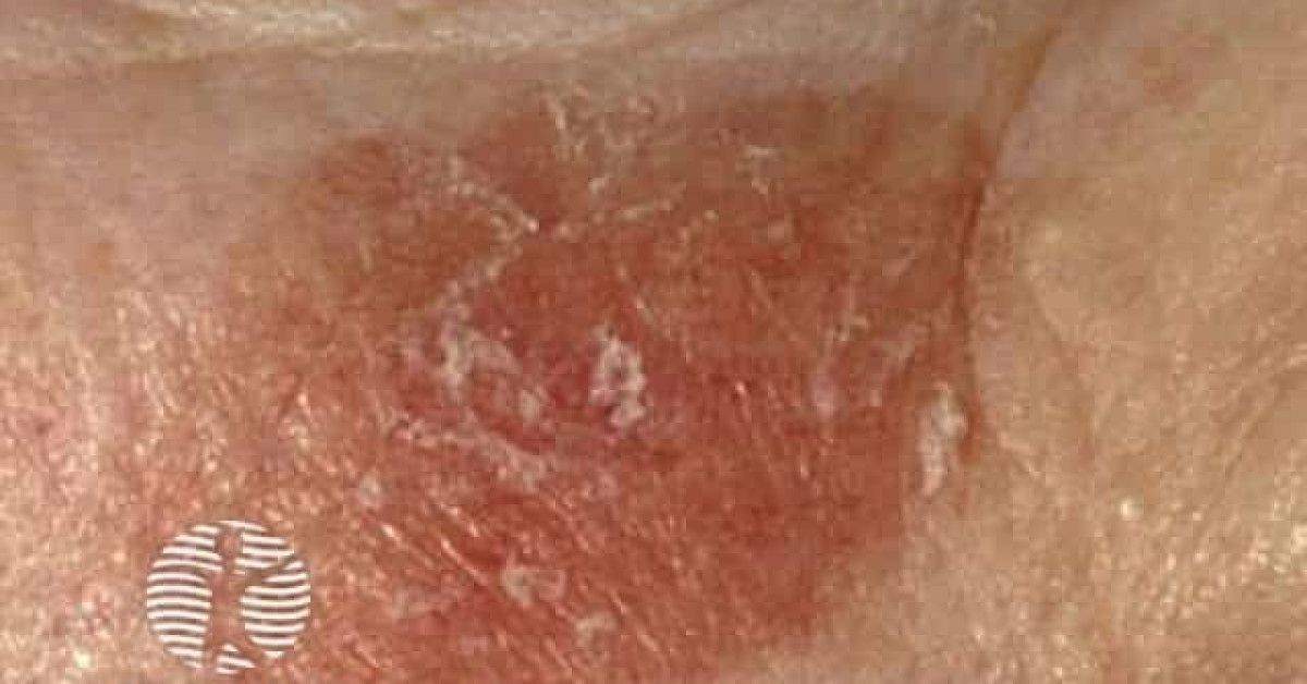 Actinic Keratoses Affecting The Face Image