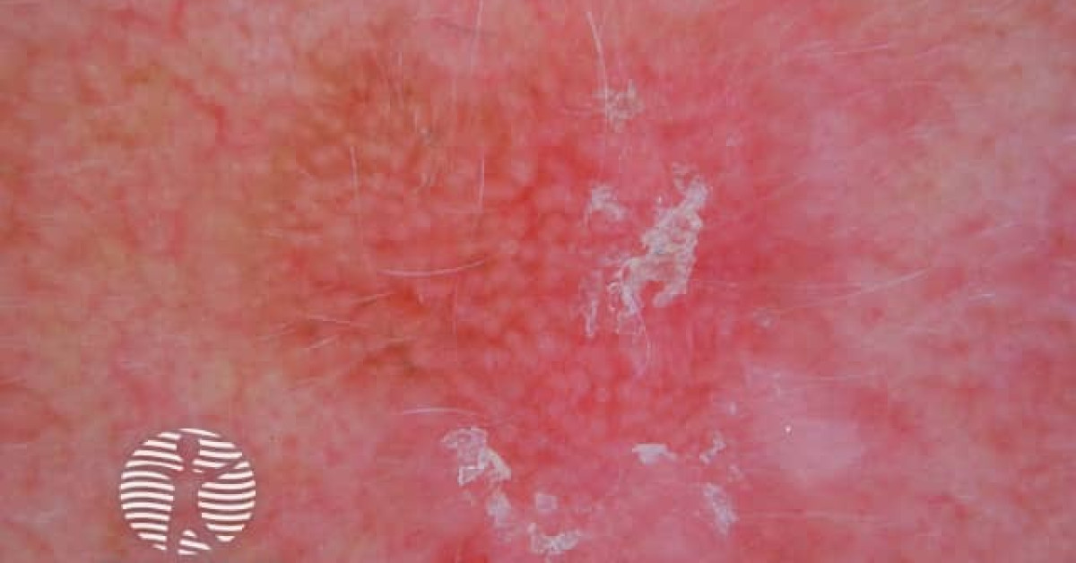 Dermoscopy of actinic keratosis on the face image