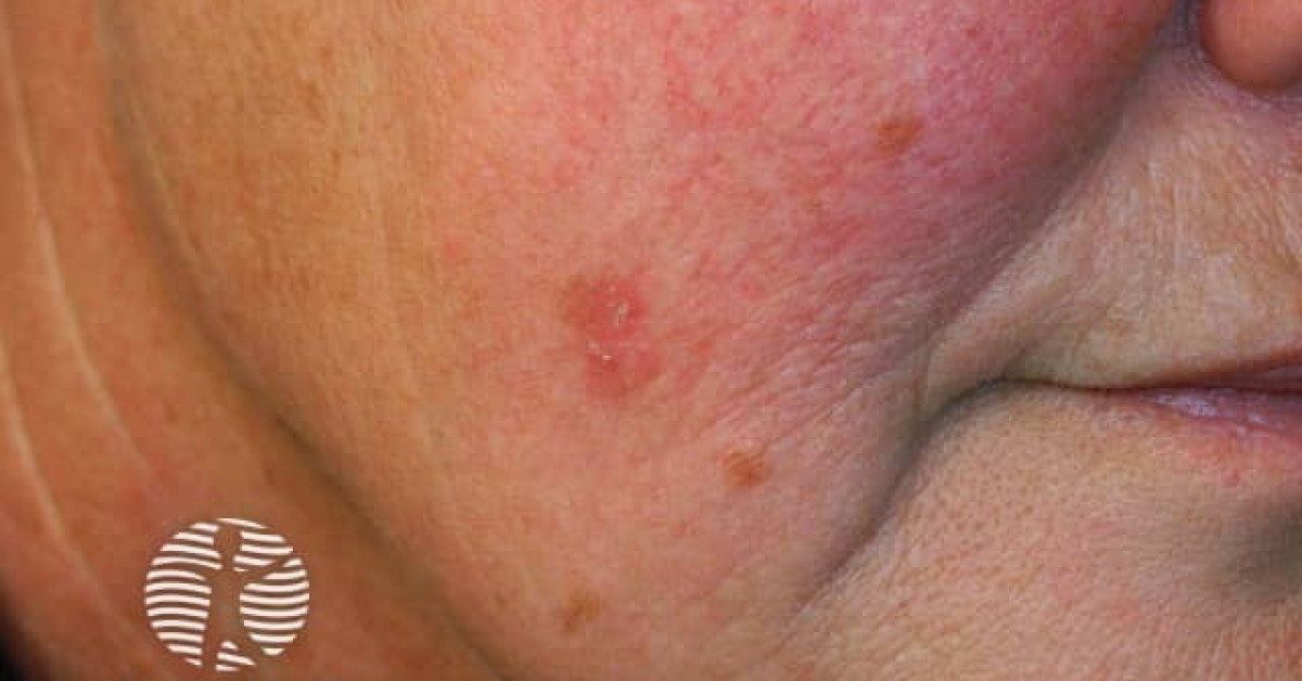 Actinic Keratoses affecting the face image