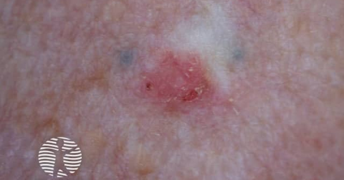 Actinic Keratoses Affecting The Face Image 8953