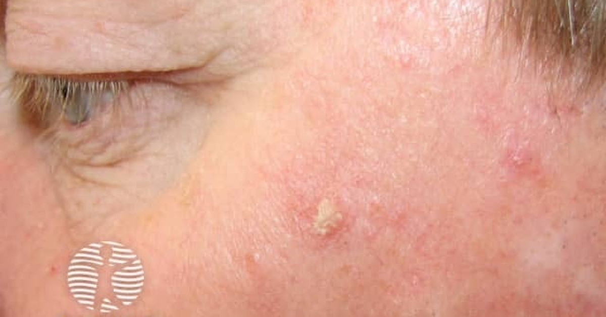 Actinic Keratoses affecting the face image