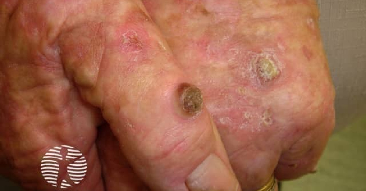 Actinic keratoses affecting the hands image
