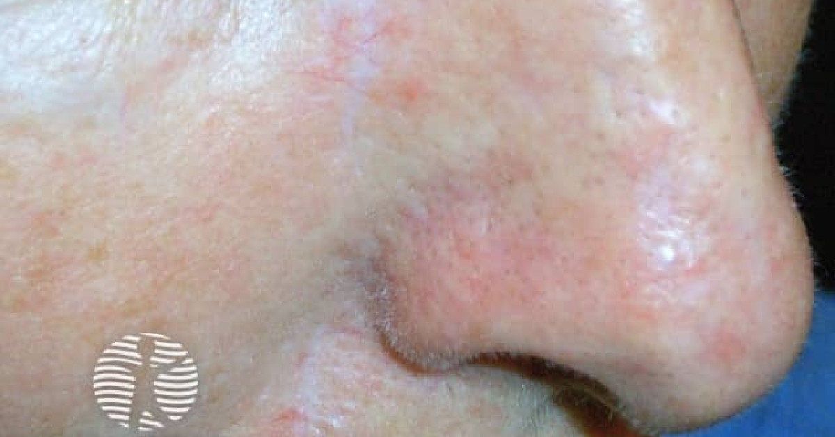 Actinic Keratoses treated with imiquimod image