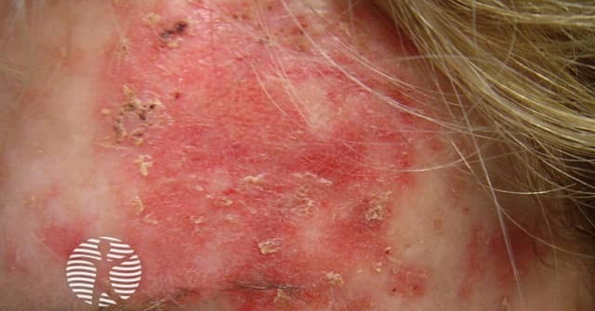 Actinic Keratoses treated with imiquimod image