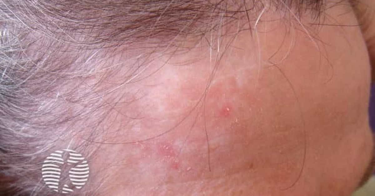 Actinic Keratoses treated with imiquimod image