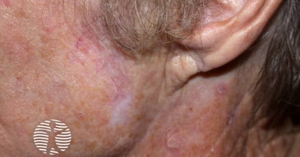 Actinic Keratoses treated with imiquimod image
