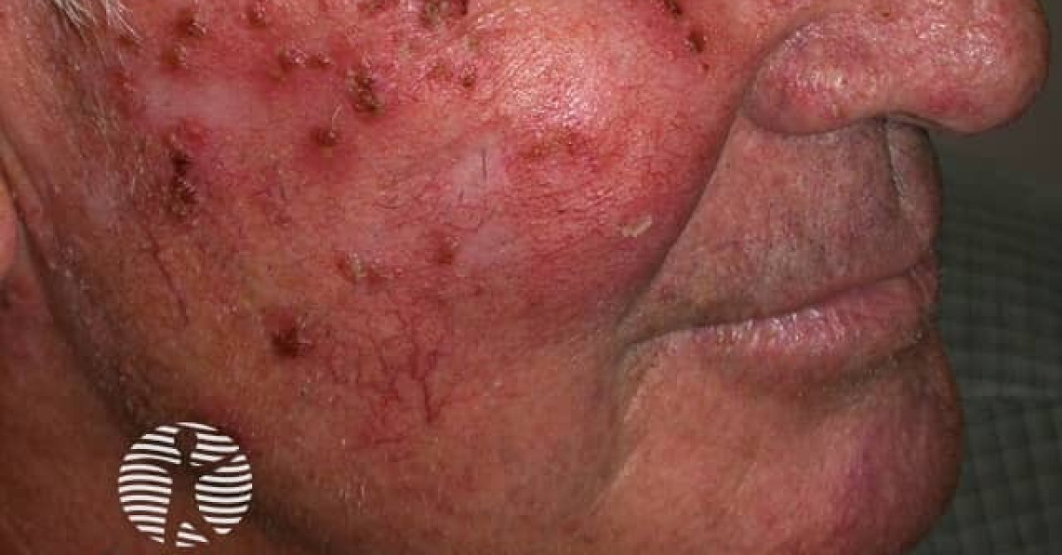 Actinic Keratoses treated with imiquimod image