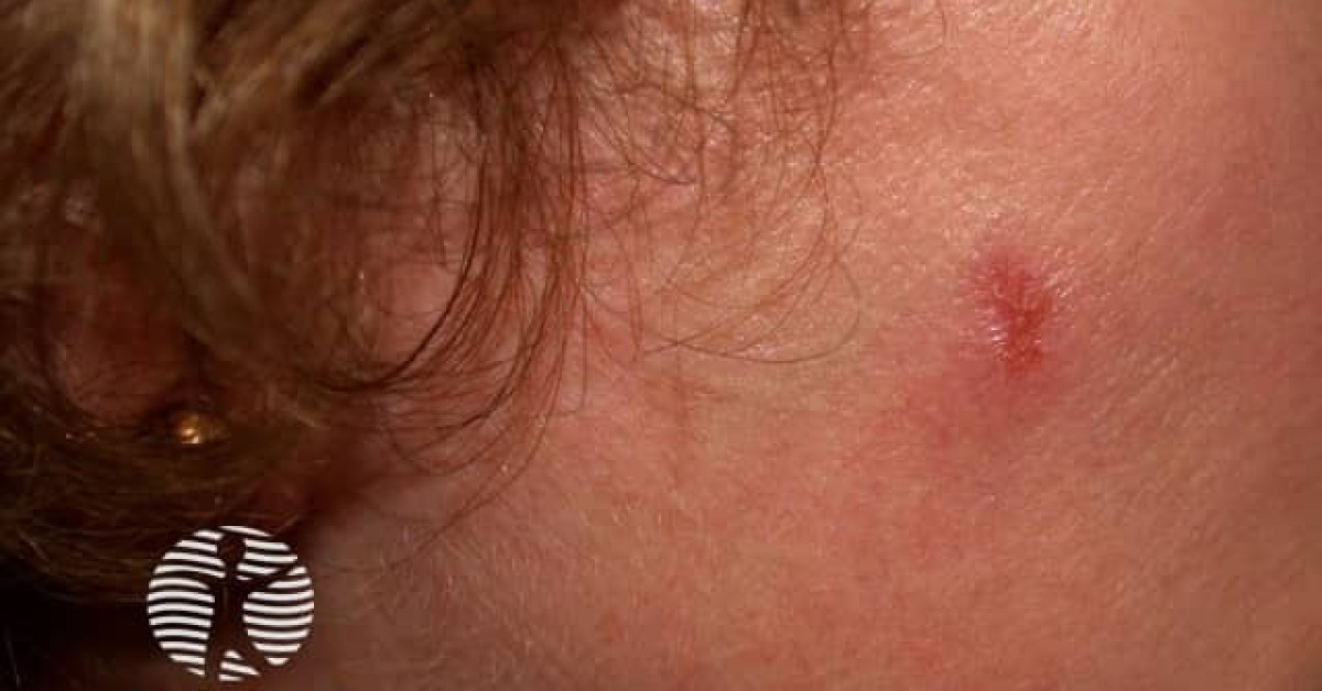 Actinic Keratoses treated with imiquimod image
