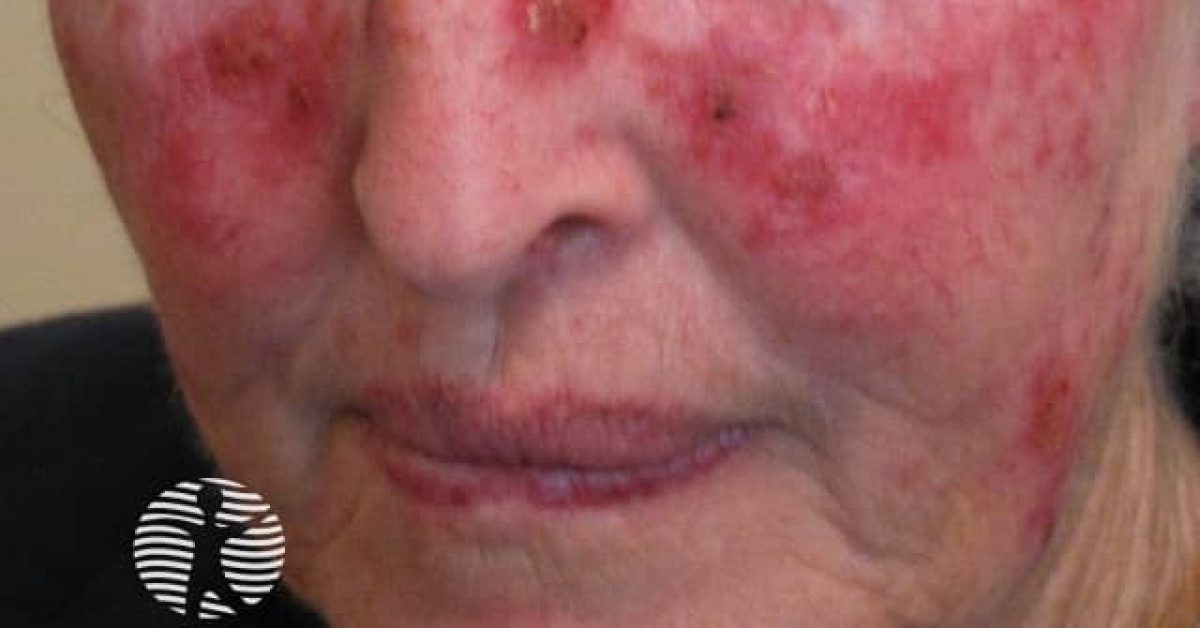 Actinic Keratoses treated with imiquimod image