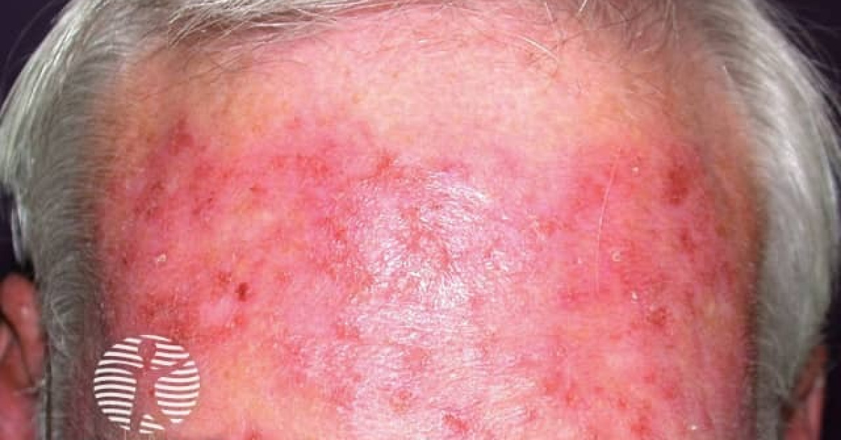 Actinic Keratoses treated with imiquimod image