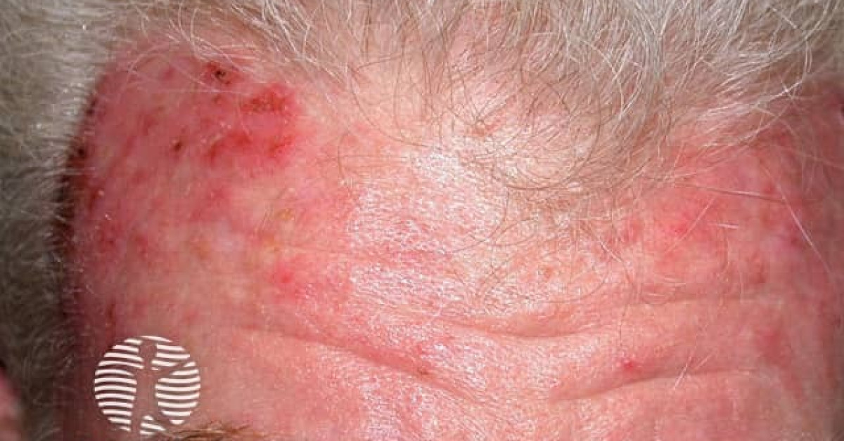 Actinic Keratoses treated with imiquimod image