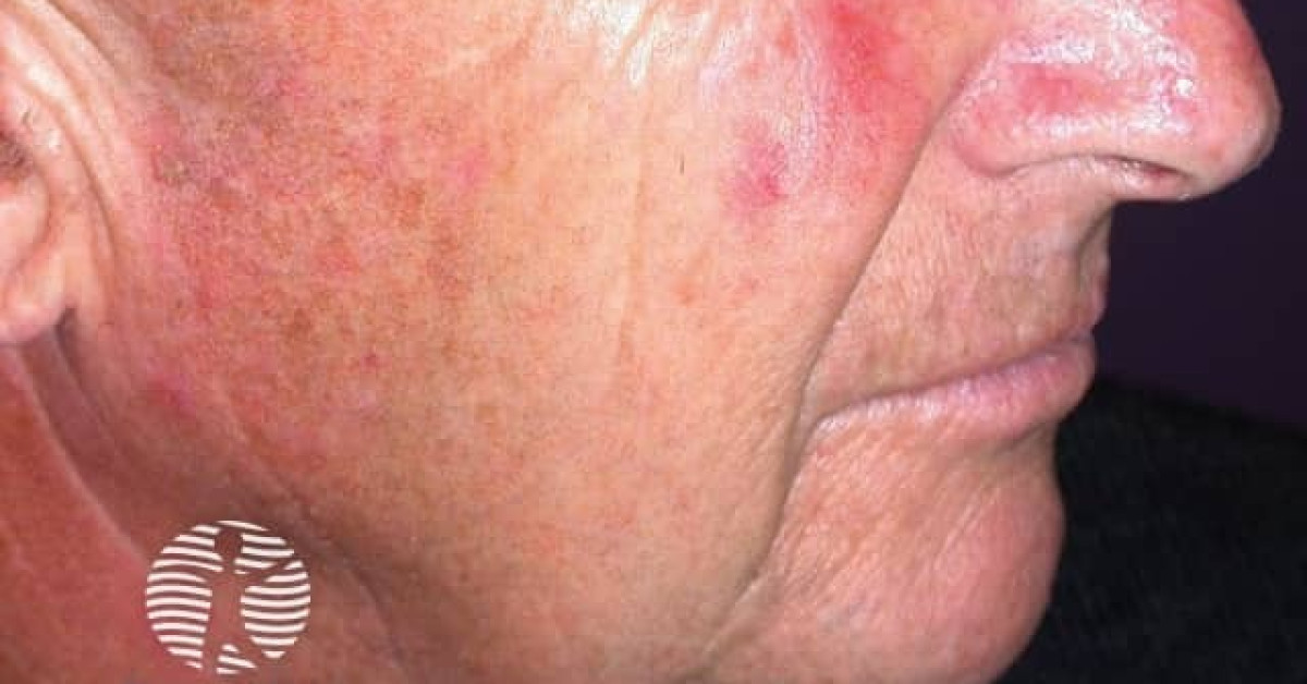 Actinic Keratoses treated with imiquimod image