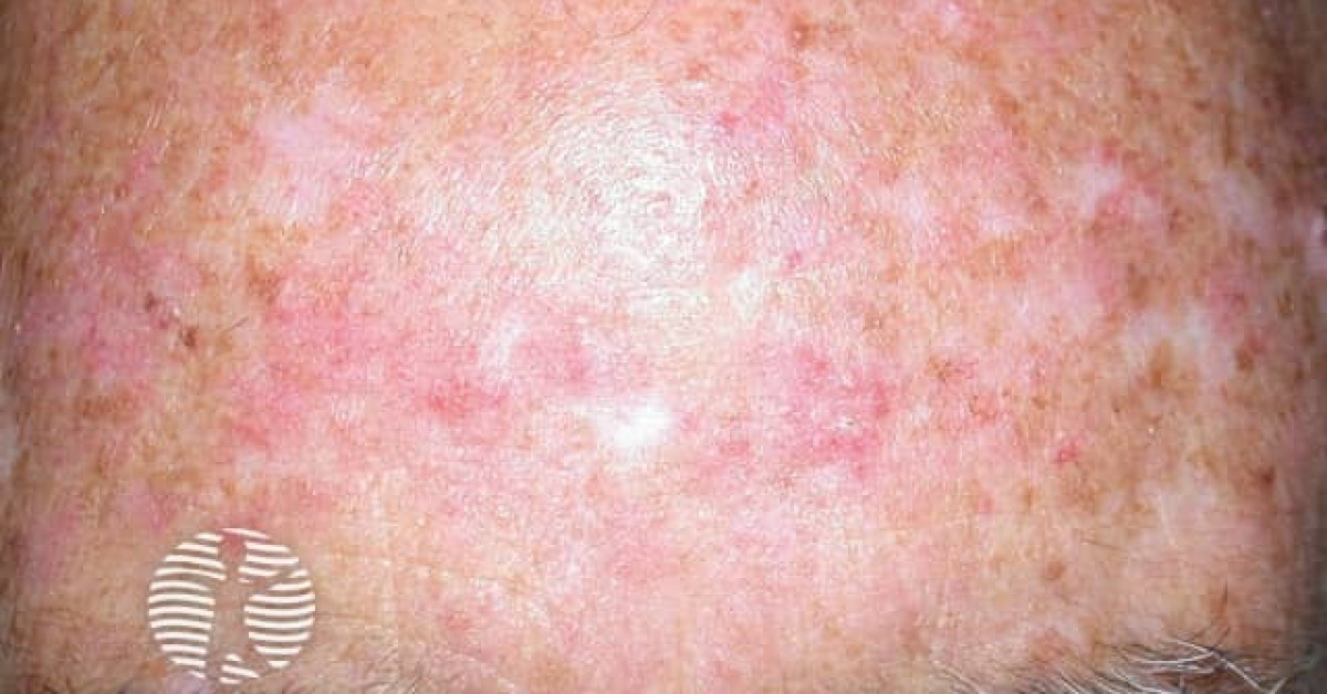 Actinic Keratoses treated with imiquimod image