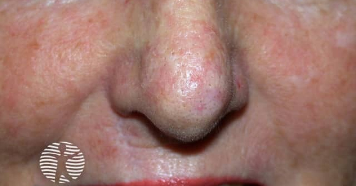Actinic Keratoses treated with imiquimod image