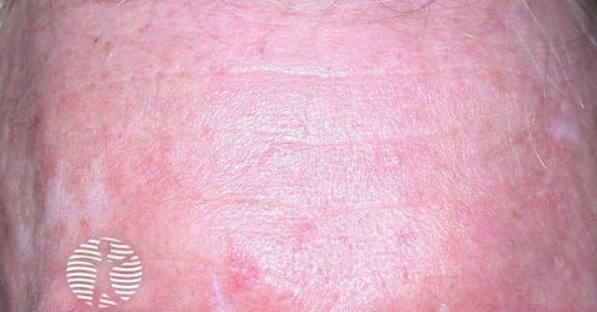 Actinic Keratoses treated with imiquimod image