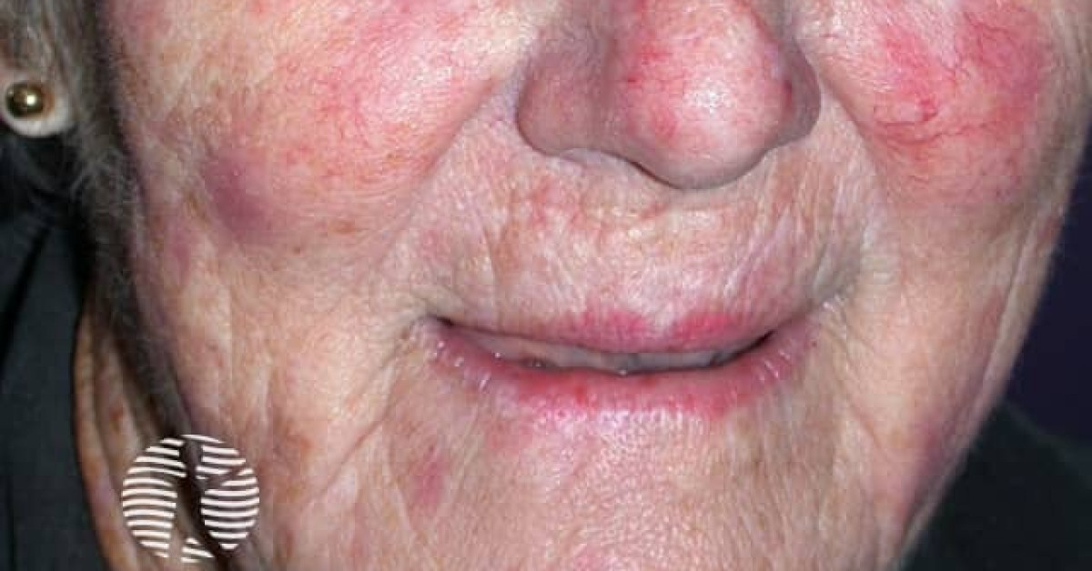 Actinic Keratoses treated with imiquimod image