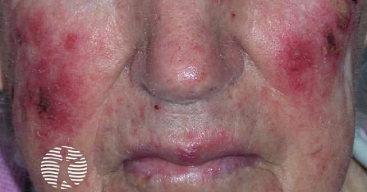 Actinic Keratoses treated with imiquimod image
