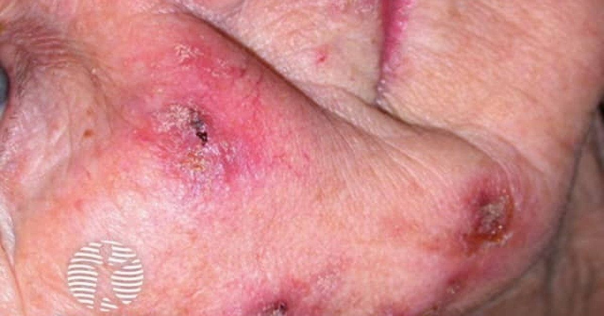 Actinic Keratoses treated with imiquimod image
