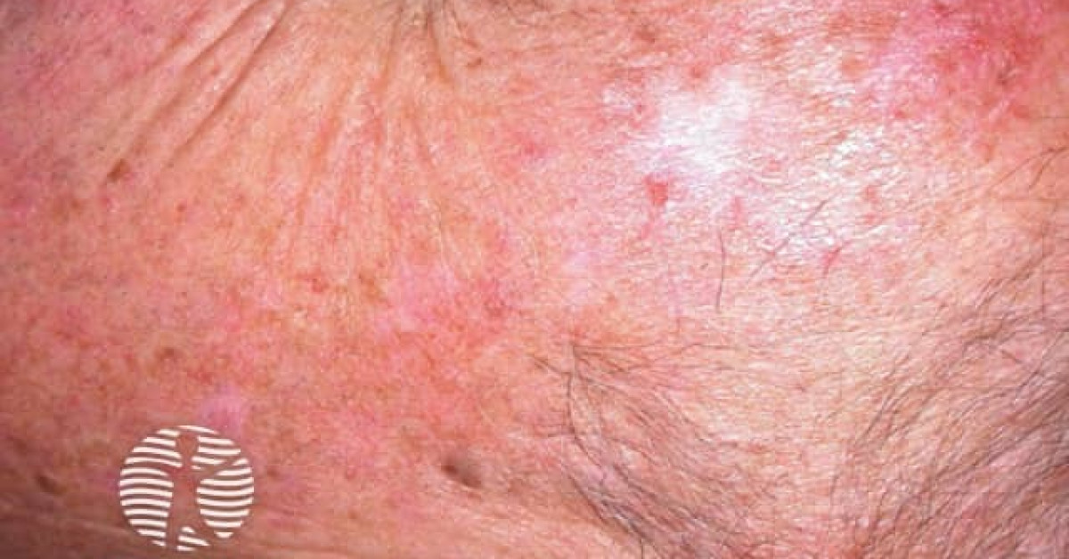 Actinic Keratoses treated with imiquimod image