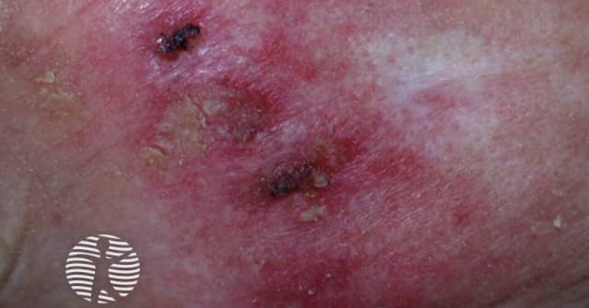 Actinic Keratoses treated with imiquimod image