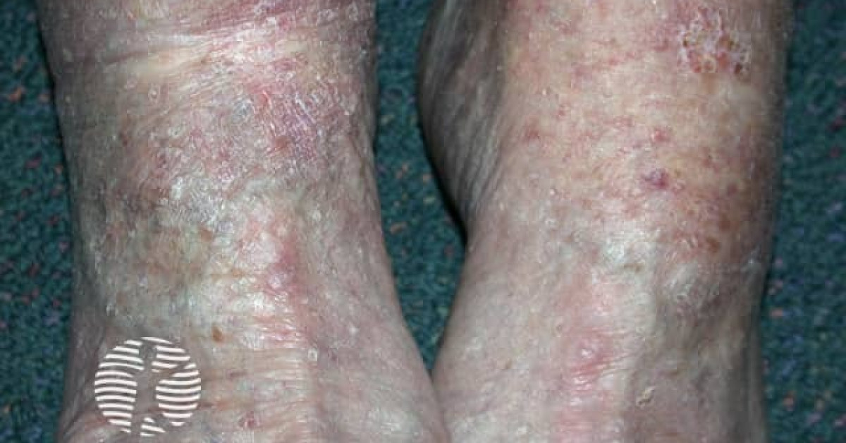 Actinic Keratoses affecting the legs and feet image