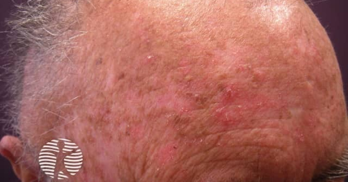 Actinic keratoses affecting the scalp image