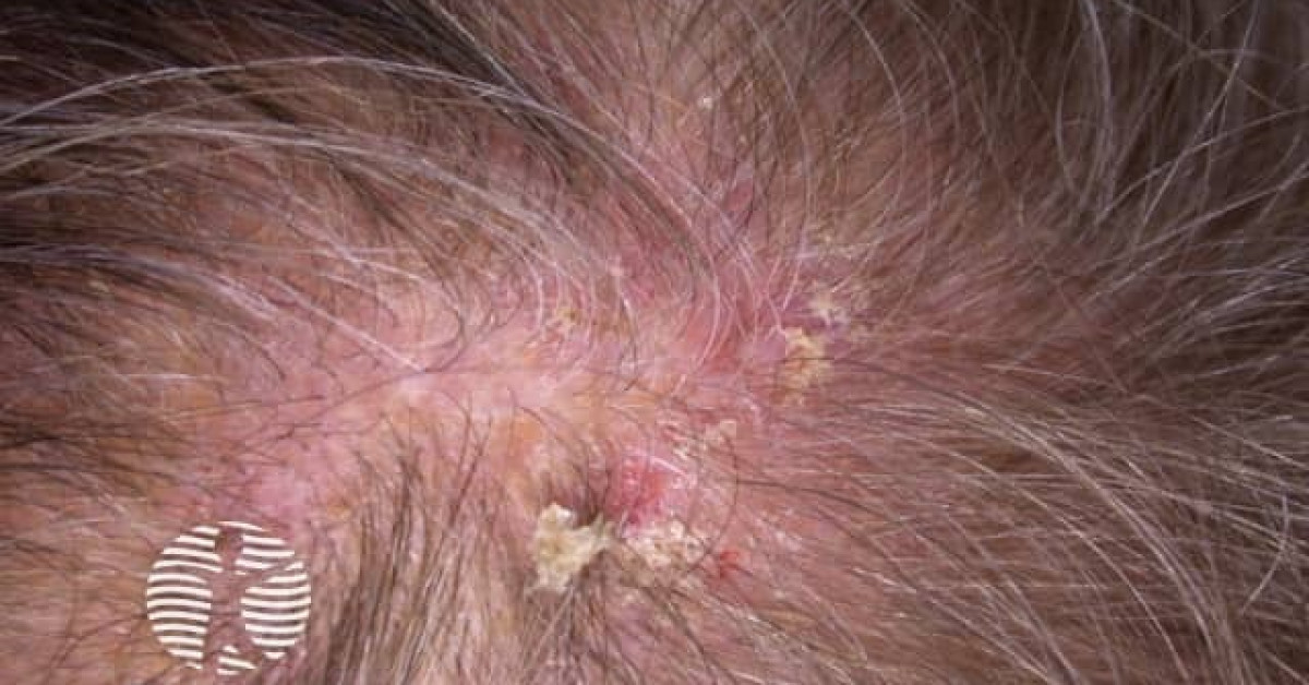 Actinic keratoses affecting the scalp image