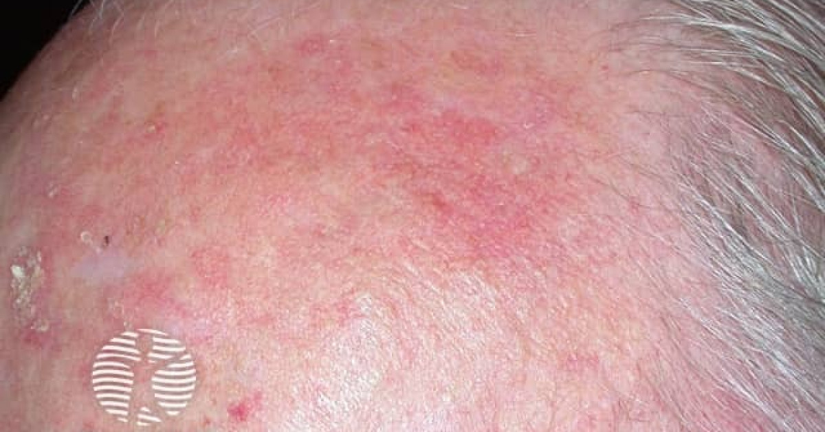 Actinic keratoses affecting the scalp image